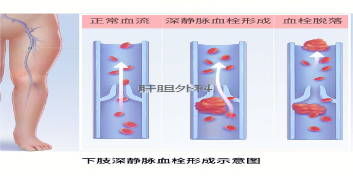 VTE---静脉血栓栓塞症 健康宣教手册